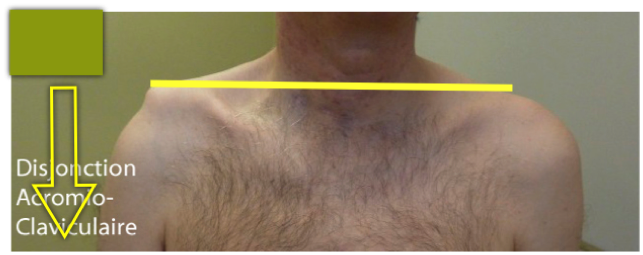 Disjonction acromio-claviculaire - Centre Epaule Main de Besançon ...