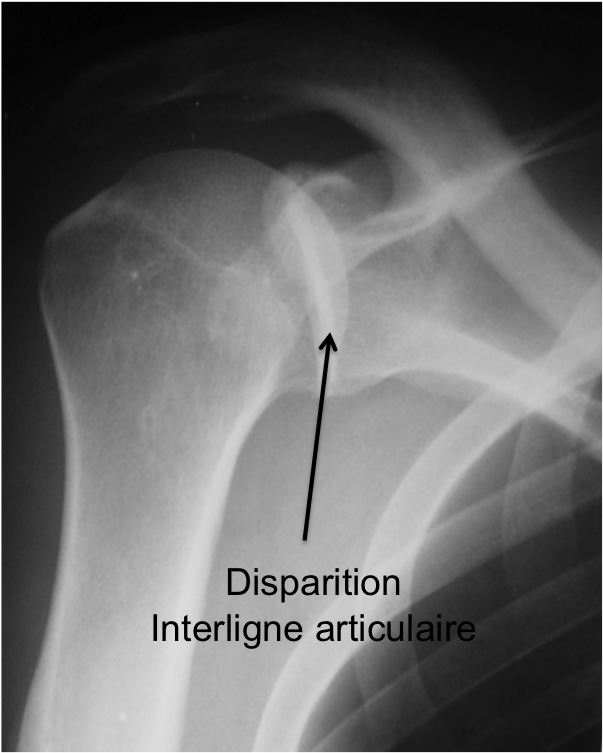 Instabilité postérieure - Centre Epaule Main de Besançon - chirurgie ...