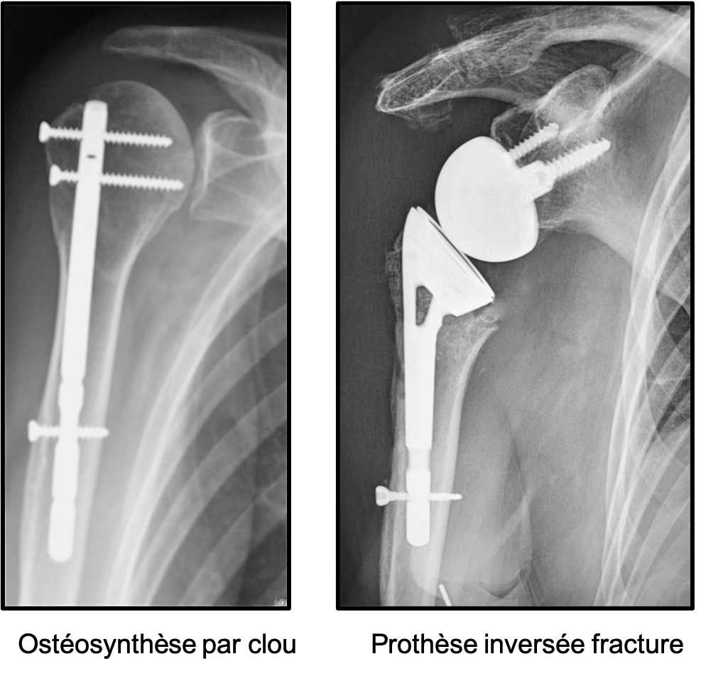 Fractures - Centre Epaule Main de Besançon - chirurgie orthopédique et ...